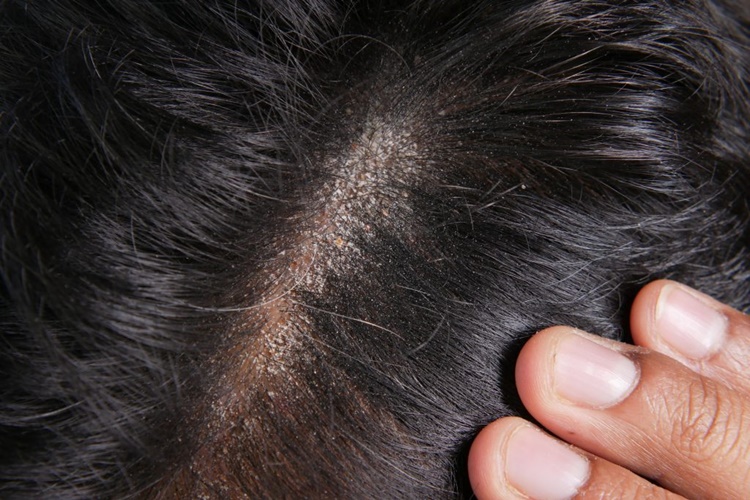 Saç Mantarı Nasıl Geçer? - Güncel Oku