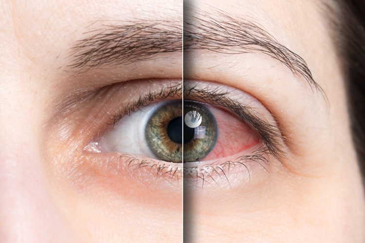 Sinüzit Gözde Yanma Yapar mı? - Güncel Oku