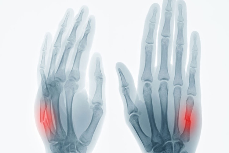 Skafoid Askerliğe Engel Mi? - Güncel Oku