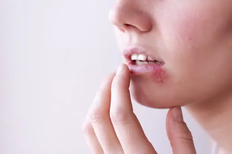 Travocort Krem Uçuk İçin Kullanılır Mı? - Güncel Oku