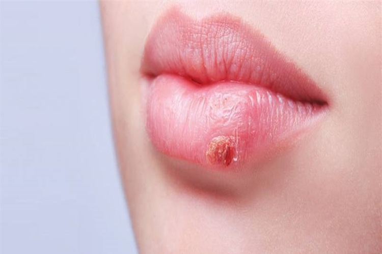 Uçuk Kalıcı Mı? - Güncel Oku