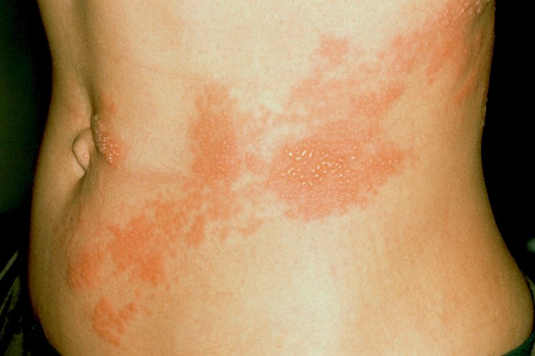 Zona Hastalığı Ölüm Riski Var Mı? - Güncel Oku