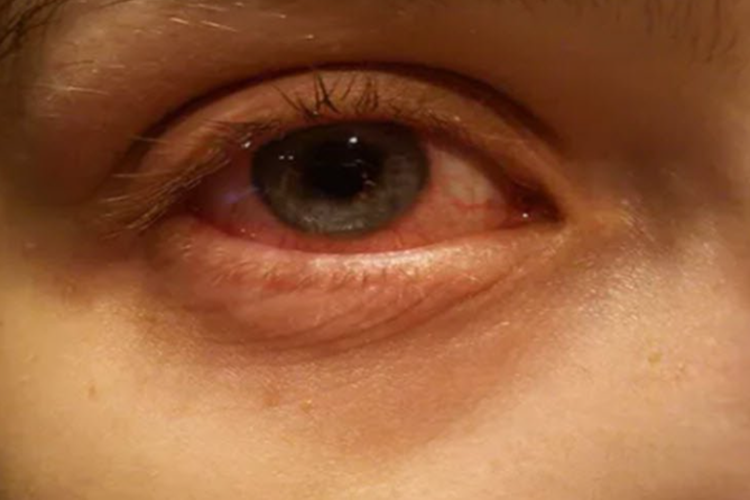 Zylet Göz Damlası Kaç Gün Kullanılır? - Güncel Oku